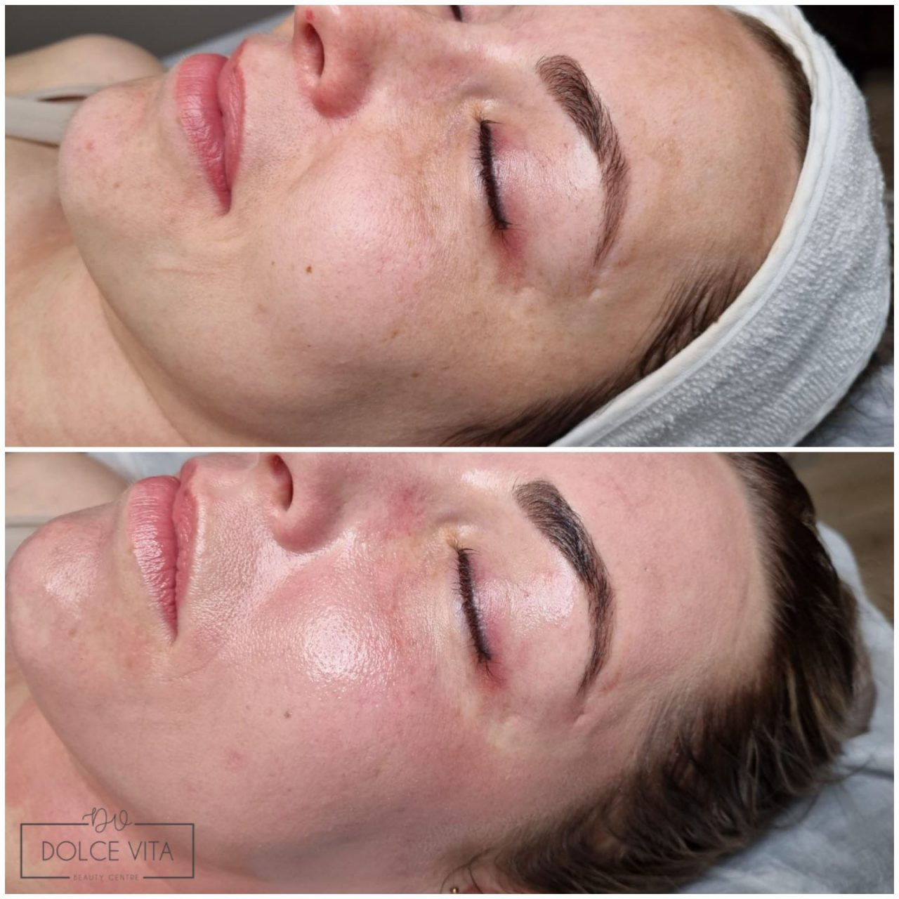 Collagen Induction Micro-Needling - Dolce Vita Beauty Centre